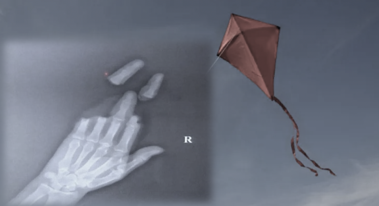 Men's fingers severed and palm cut open by kite string in Jiangsu ...