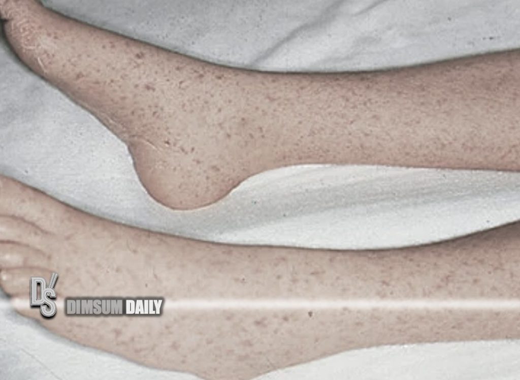 First two monkeypox cases confirmed in Canada - Dimsum Daily