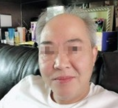 6.5 by 5.5cm impact crack caused by a hard object on skull found by ...