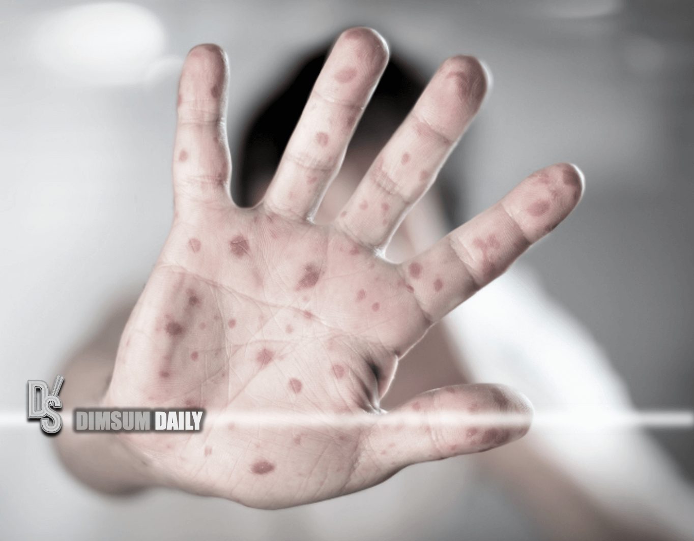 Another confirmed case of Mpox reported by CHP involving 51-year-old ...
