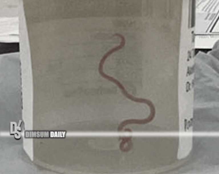 Live parasitic worm found in Australian woman's brain - Dimsum Daily