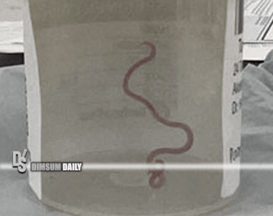 Live parasitic worm found in Australian woman's brain - Dimsum Daily