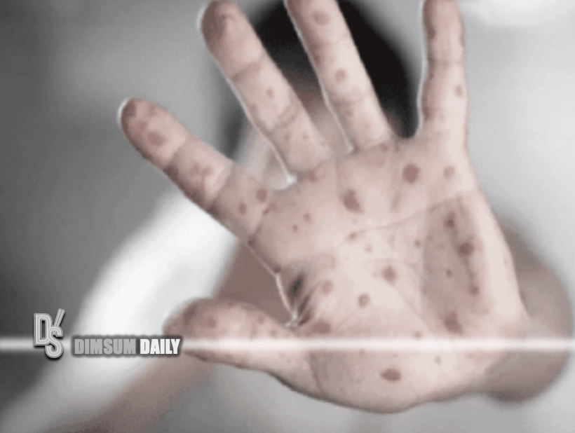 Another confirmed Mpox case involving 30-year-old man under ...
