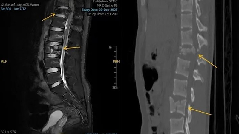 Shanghai teenager suffers multiple fractures after falling from sixth ...