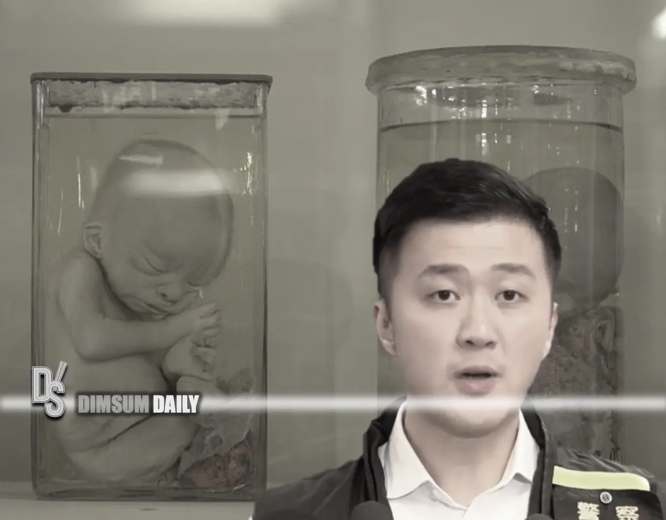 Suspected formalin solution used to preserve two 24-30-week-old infant ...