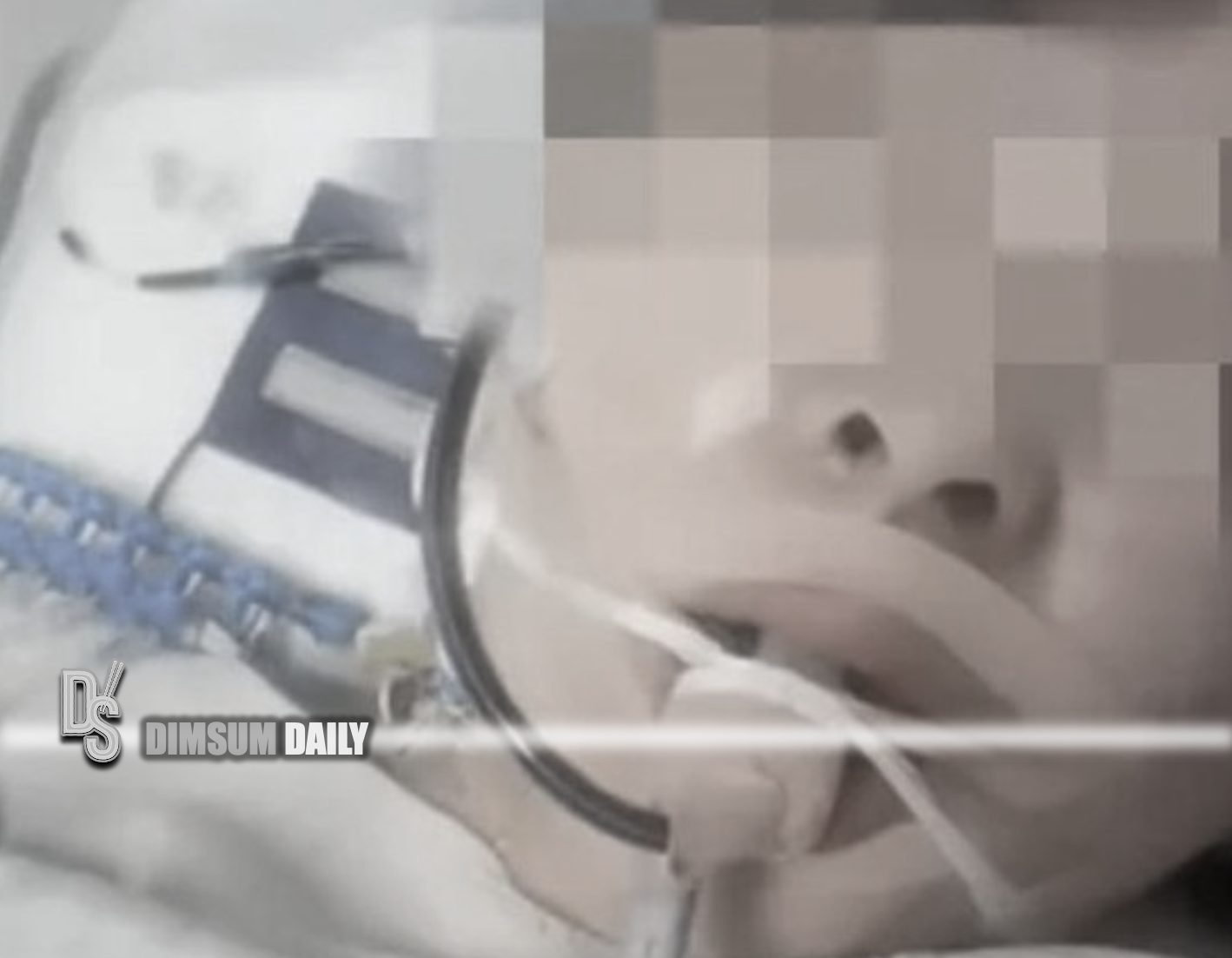 Chinese woman in coma for over 90 hours after genital cosmetic surgery ...