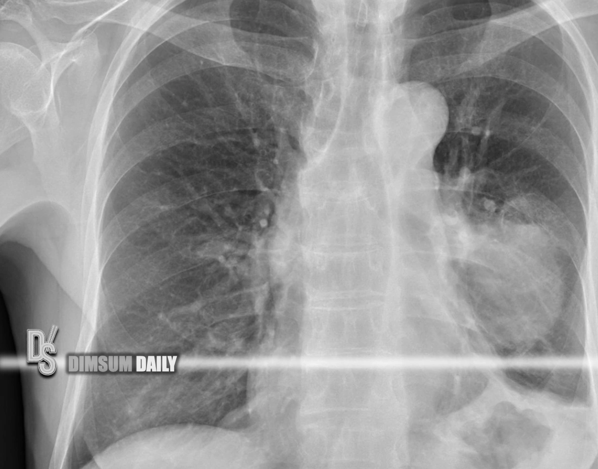 60-year-old woman in Taiwan diagnosed with late-stage lung cancer ...
