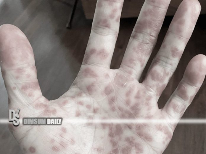 Hong Kong reports imported Mpox case - Dimsum Daily