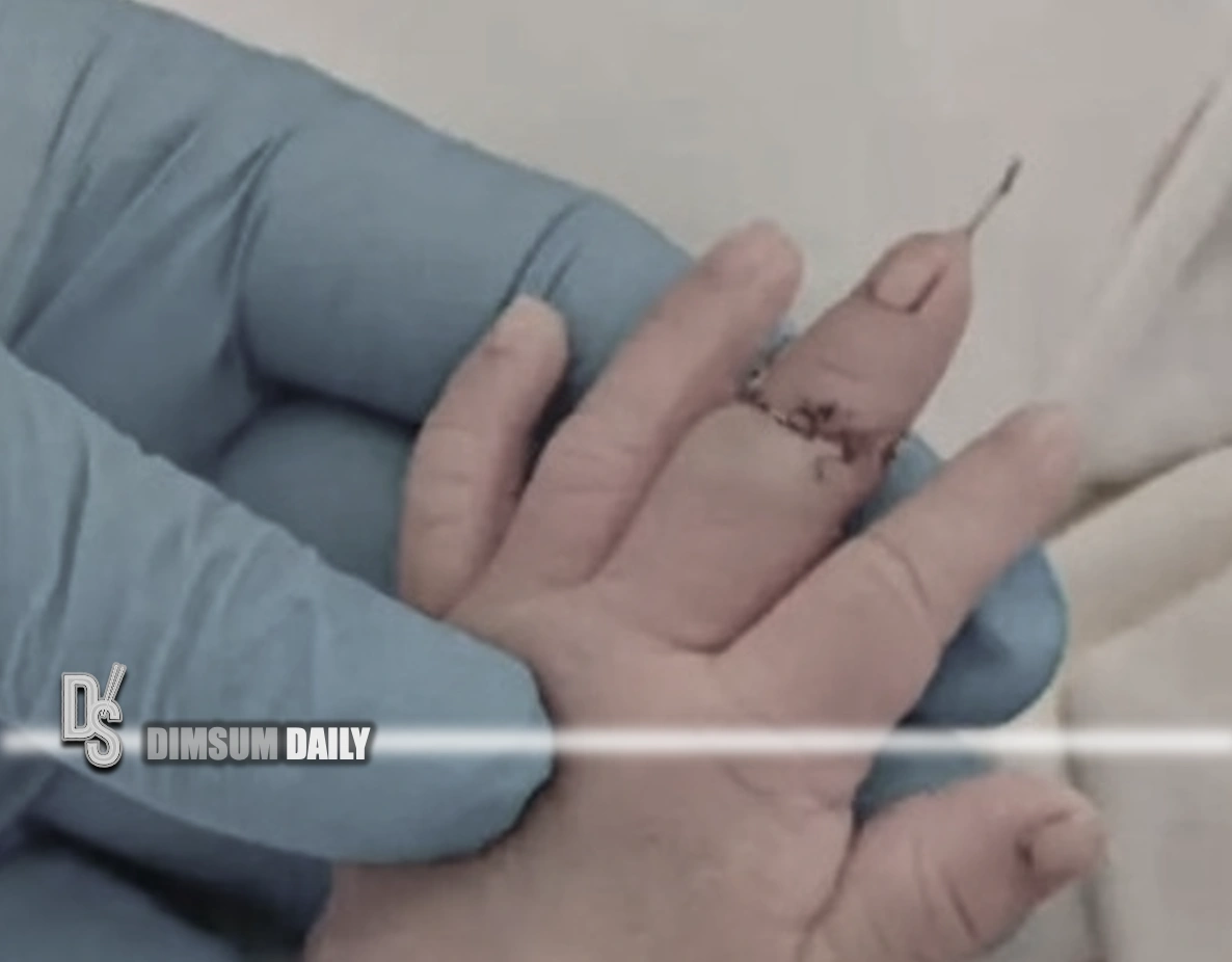 Newborn’s finger severed in startling hospital blunder during birth