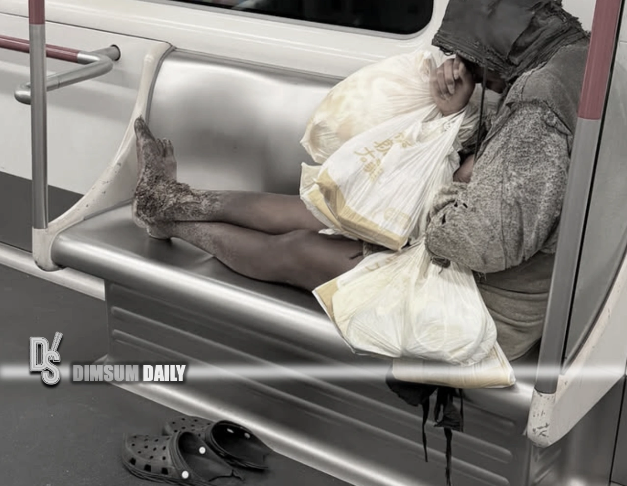 Homeless man's swollen, infected feet draw attention while occupying ...
