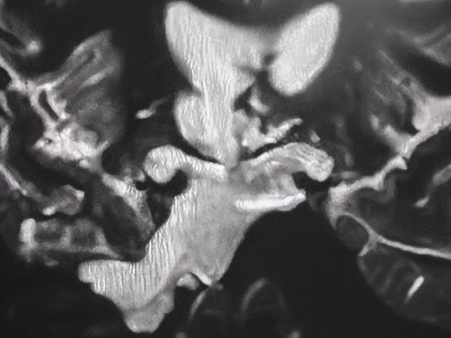 Hunan woman's runny nose turns out to be life-threatening 'brain fluid ...
